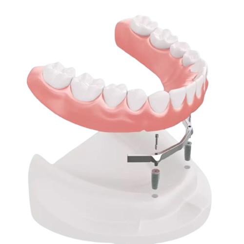 Steg – und Geschiebeprothesen – H & R Dentaltechnik GmbH